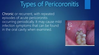 Pericoronitis | PPTX