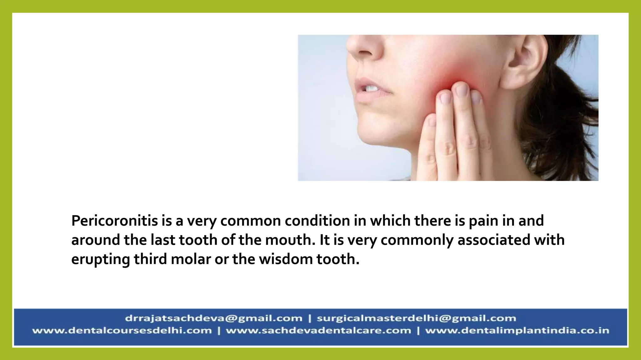 Pericoronitis | PPTX