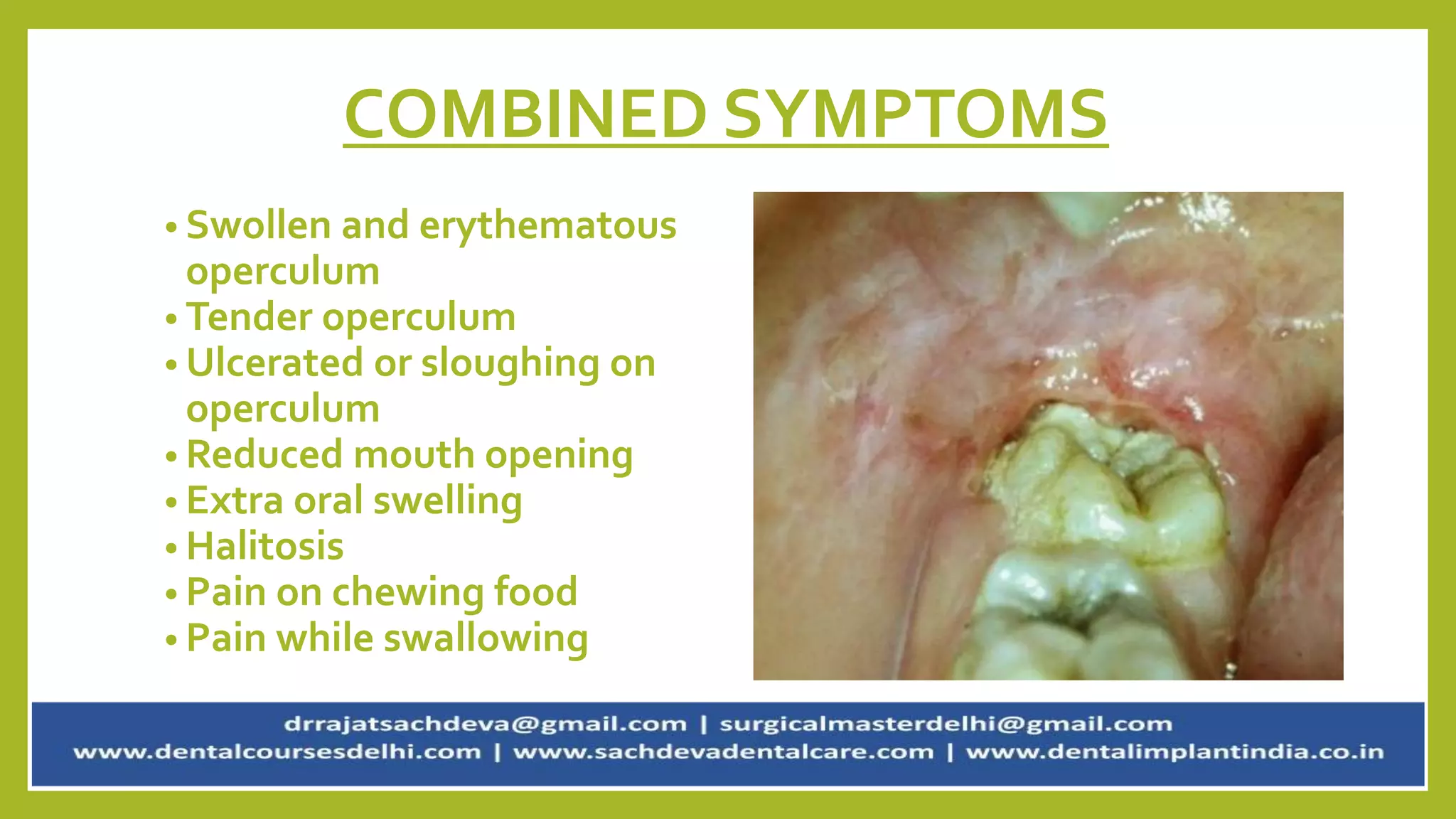 Pericoronitis | PPTX