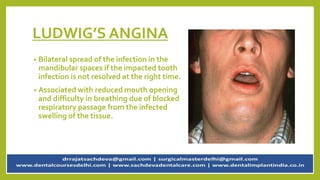 Pericoronitis | PPTX