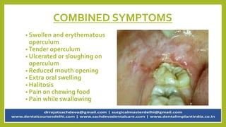 Pericoronitis | PPTX