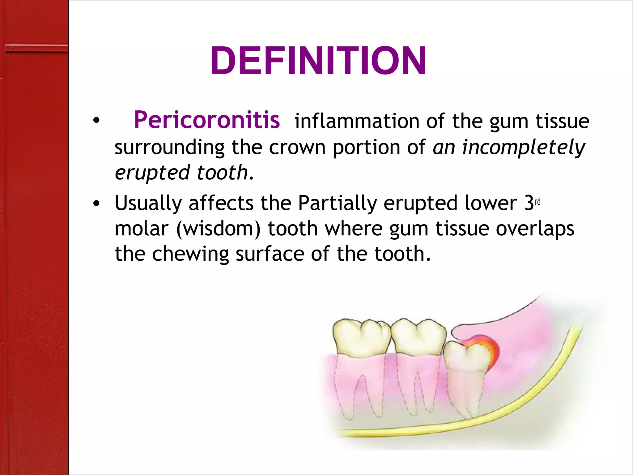 Pericoronitis | PPT