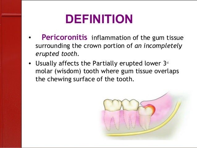 Pericoronitis