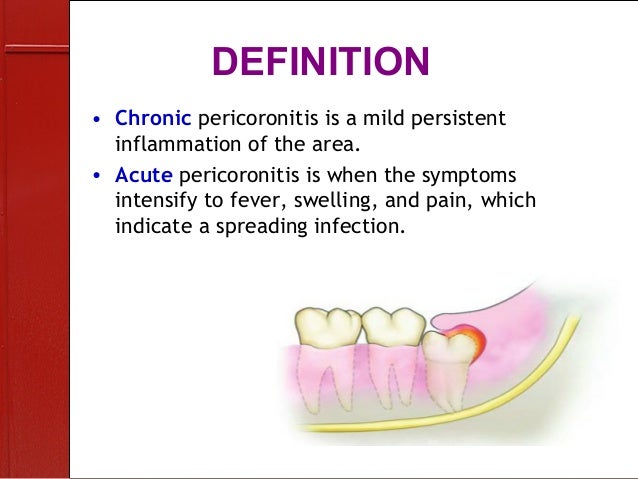Pericoronitis