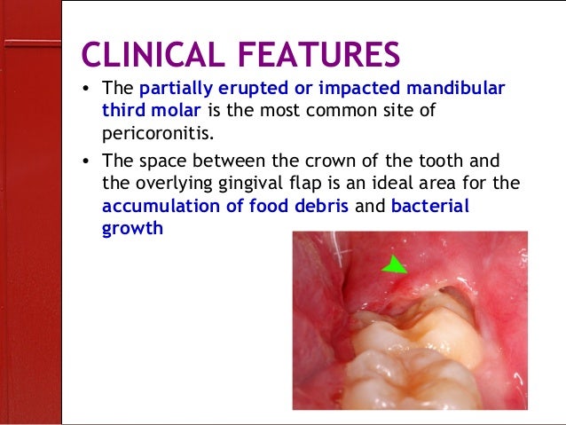 Pericoronitis