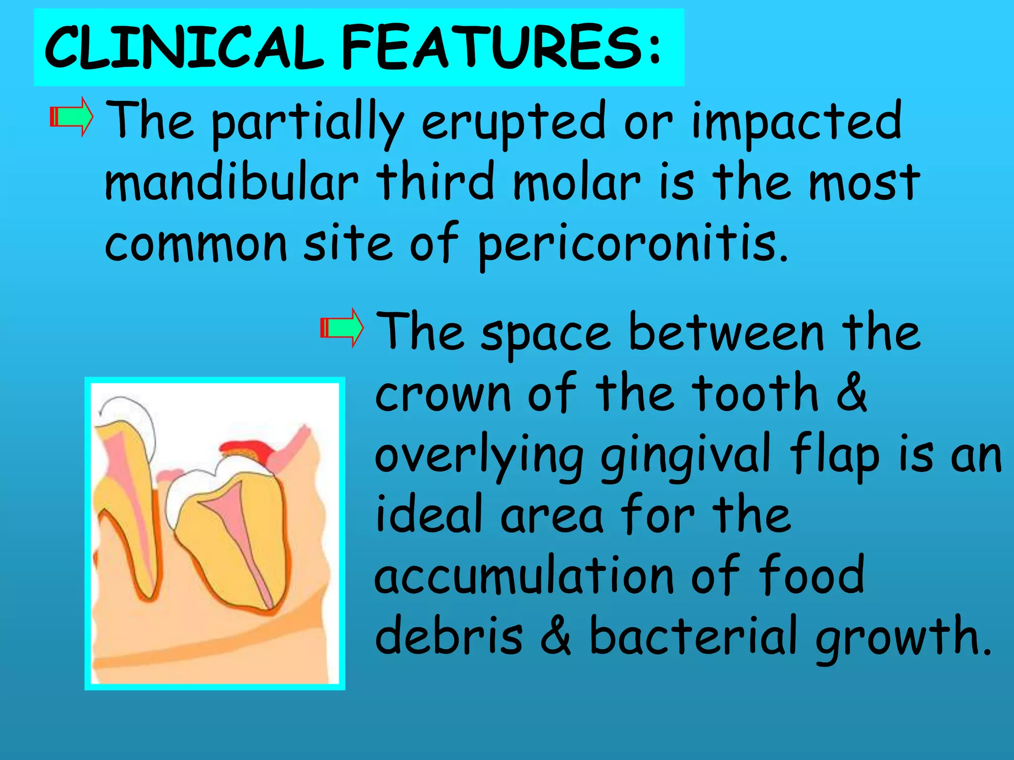 Pericoronitis | PPTX