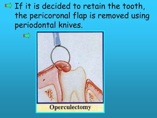Pericoronitis | PPTX