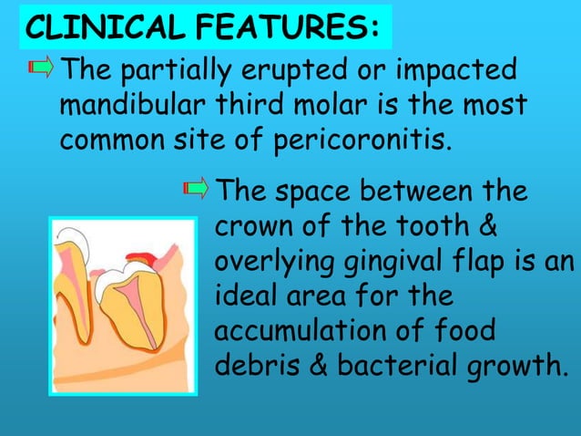 Pericoronitis | PPTX