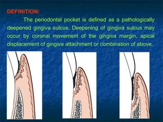 Peridontal-Pocket-Perio study guide exam | PPT