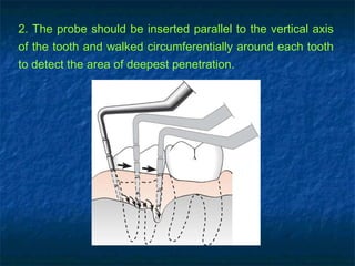 Peridontal-Pocket-Perio study guide exam | PPT