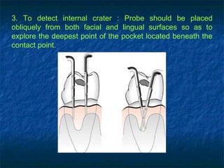 Peridontal pocket | PPT