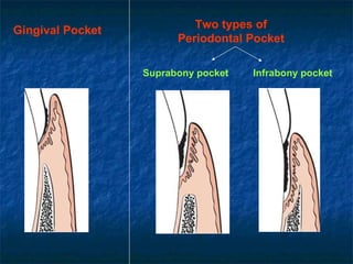 Peridontal pocket | PPT