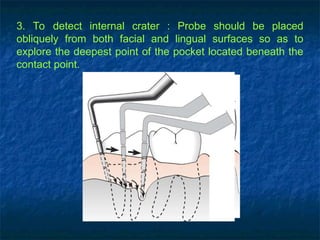 Periodontology __periodontal pocket ____ | PPT