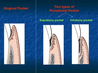 Periodontology __periodontal pocket ____ | PPT