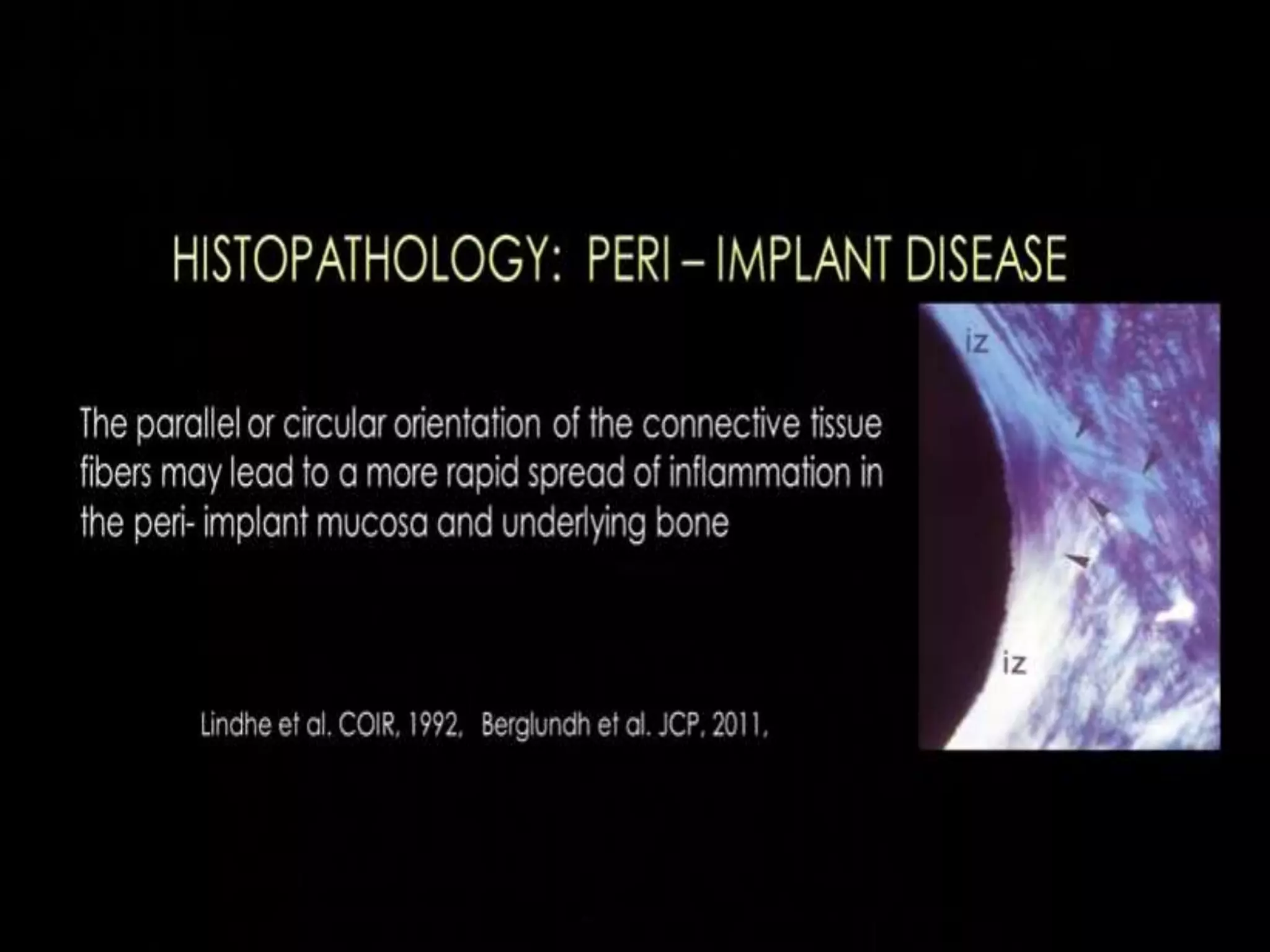 Peri implantitis | PPTX