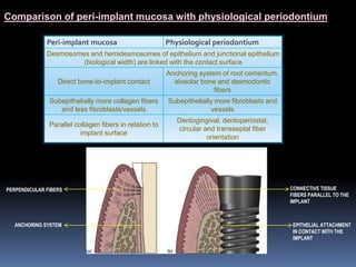 Peri implantitis | PPTX