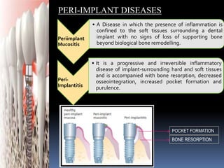 Peri implantitis | PPTX
