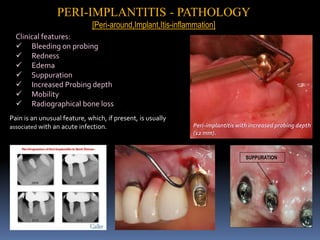 Peri implantitis | PPT