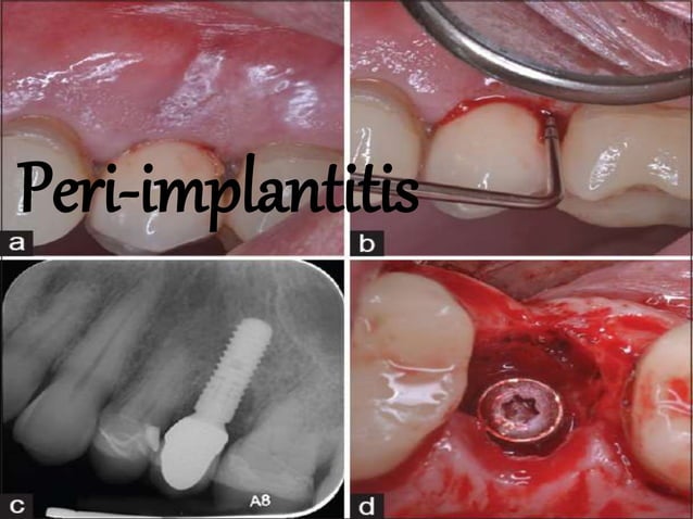 Peri implantitis | PPT