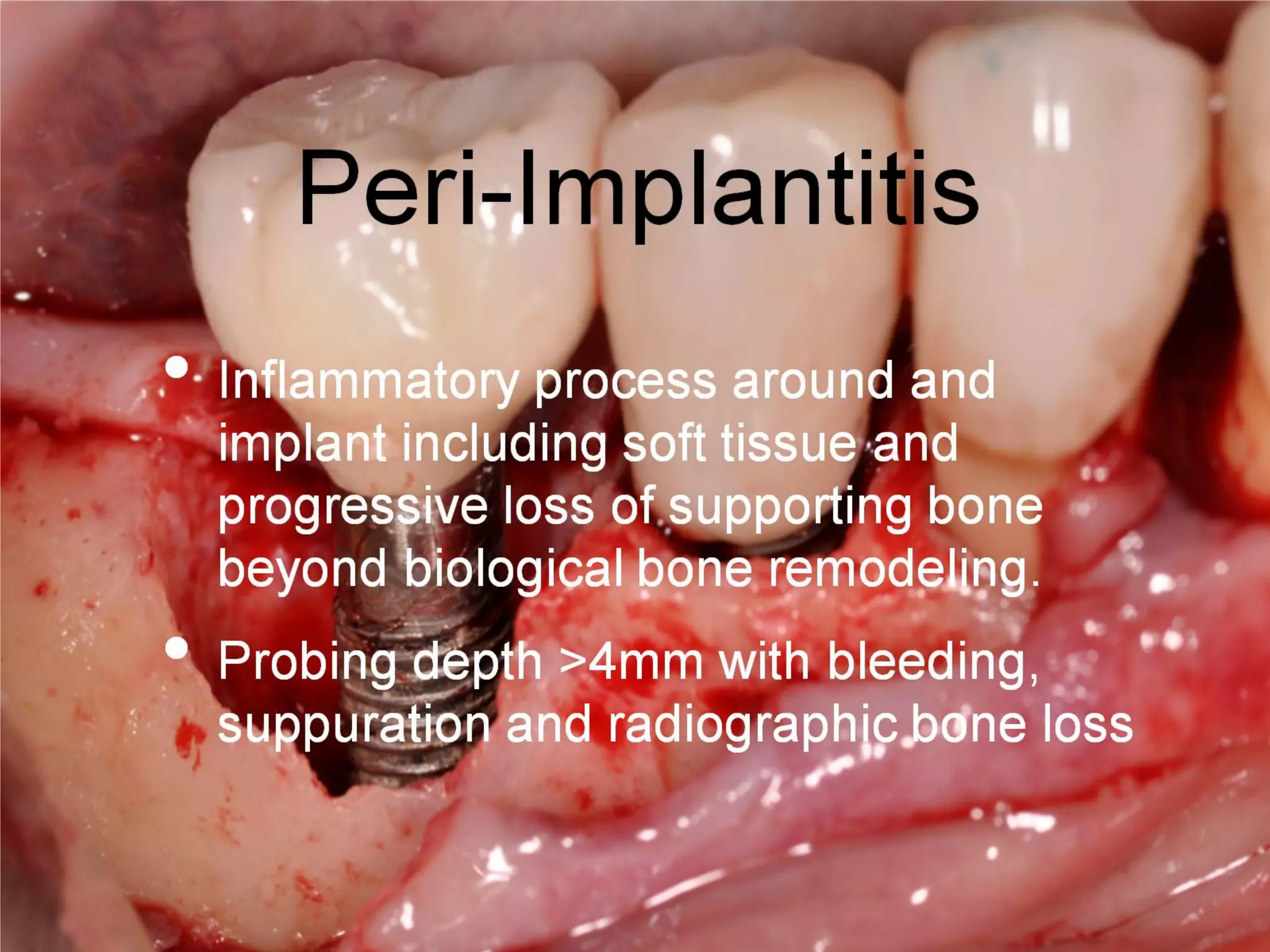 Peri implantitis | PDF