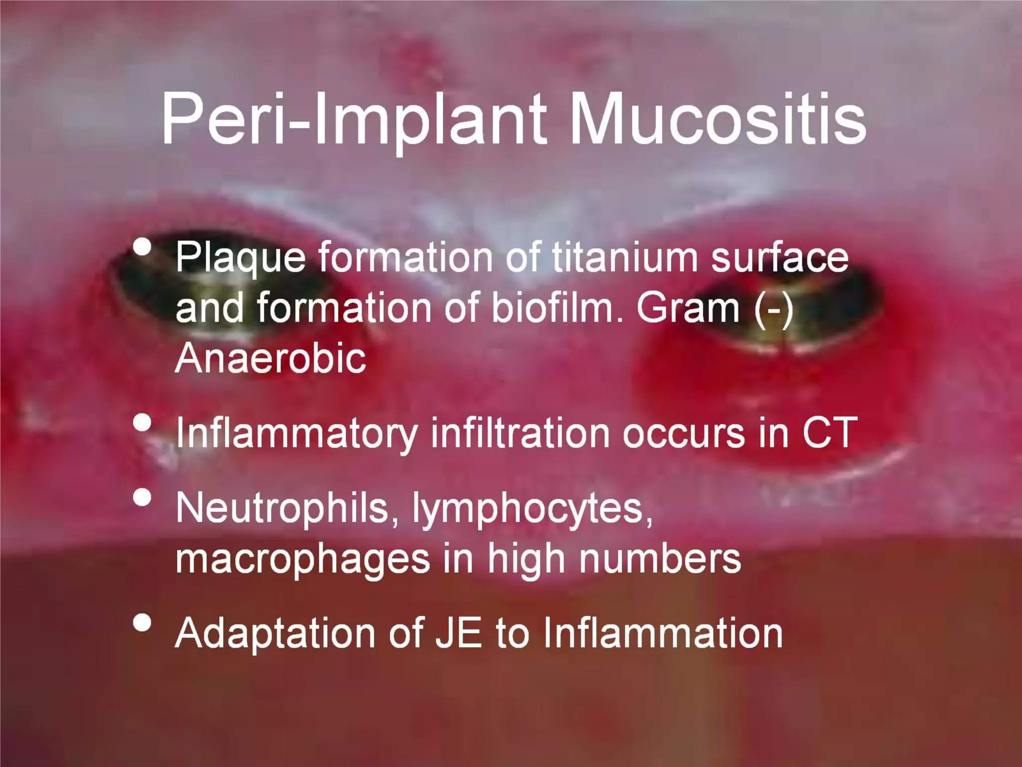 Peri implantitis | PDF