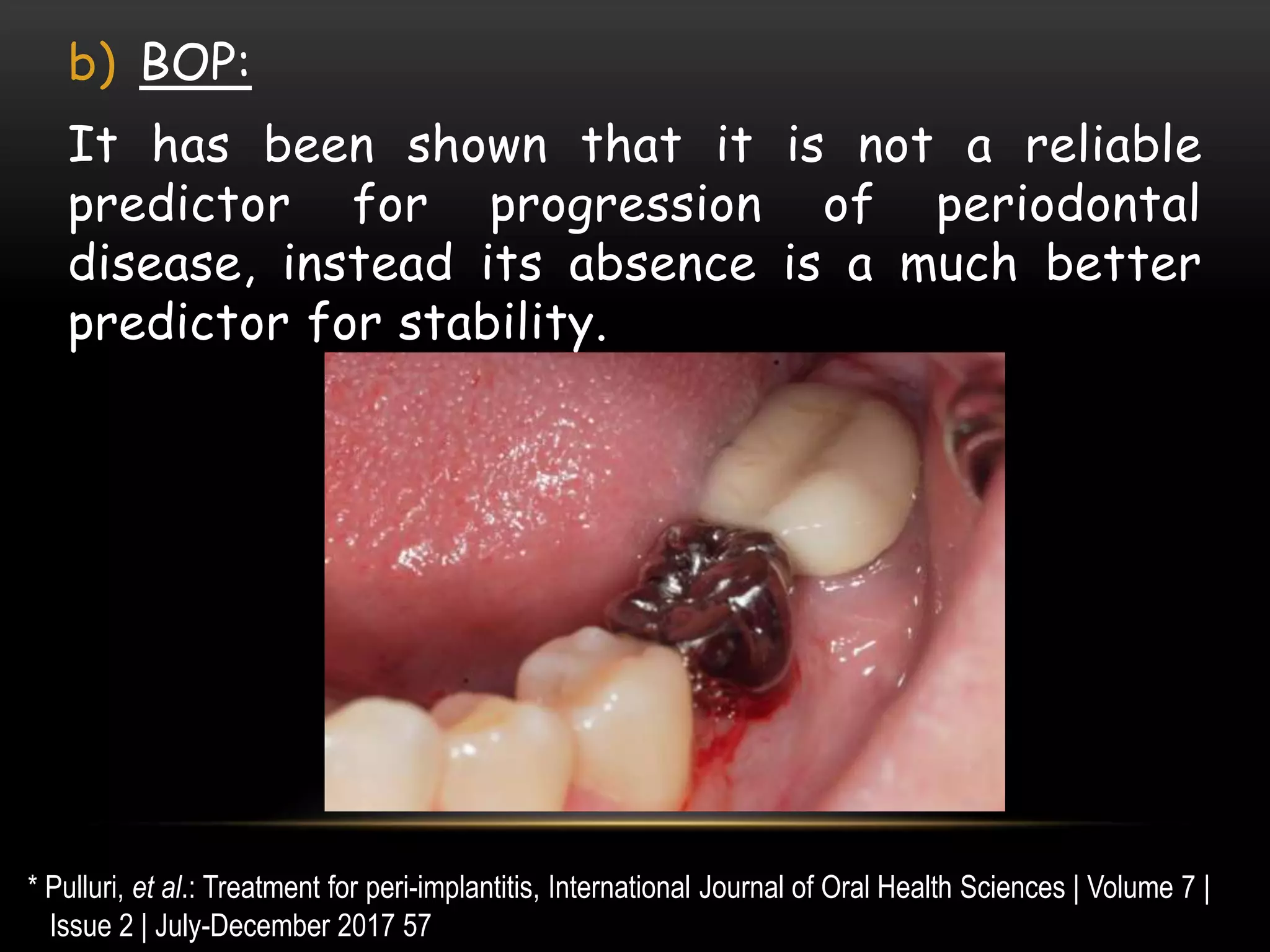 Periimplantitis | PPTX
