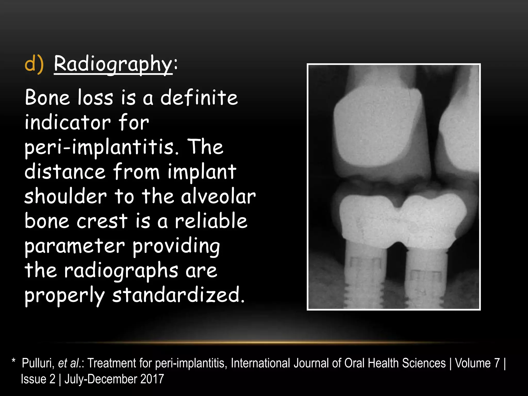 Periimplantitis | PPTX