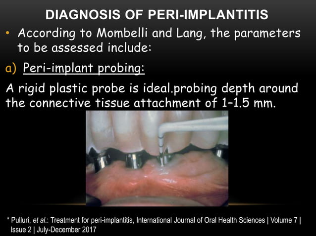 Periimplantitis | PPTX