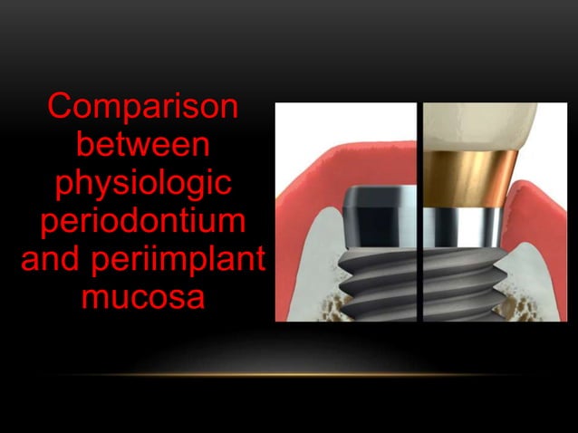 Periimplantitis | PPTX