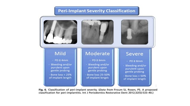 Peri implant diseases and its management | PPTX | Dental Health | Diseases and Conditions