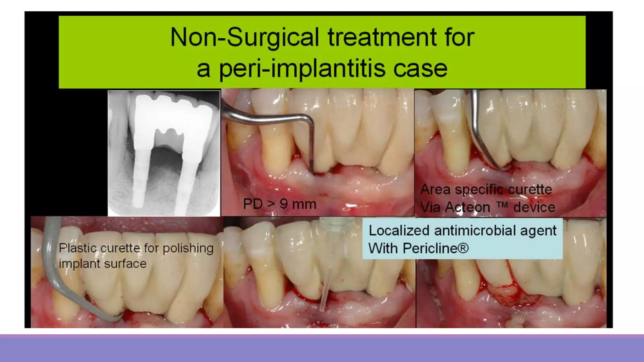 Periimplantitis | PPTX