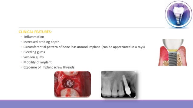 Periimplantitis | PPTX