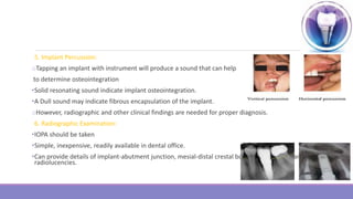 Periimplantitis | PPTX