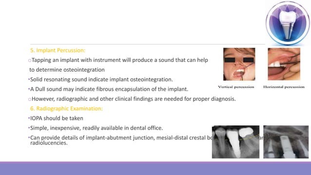 Periimplantitis | PPTX