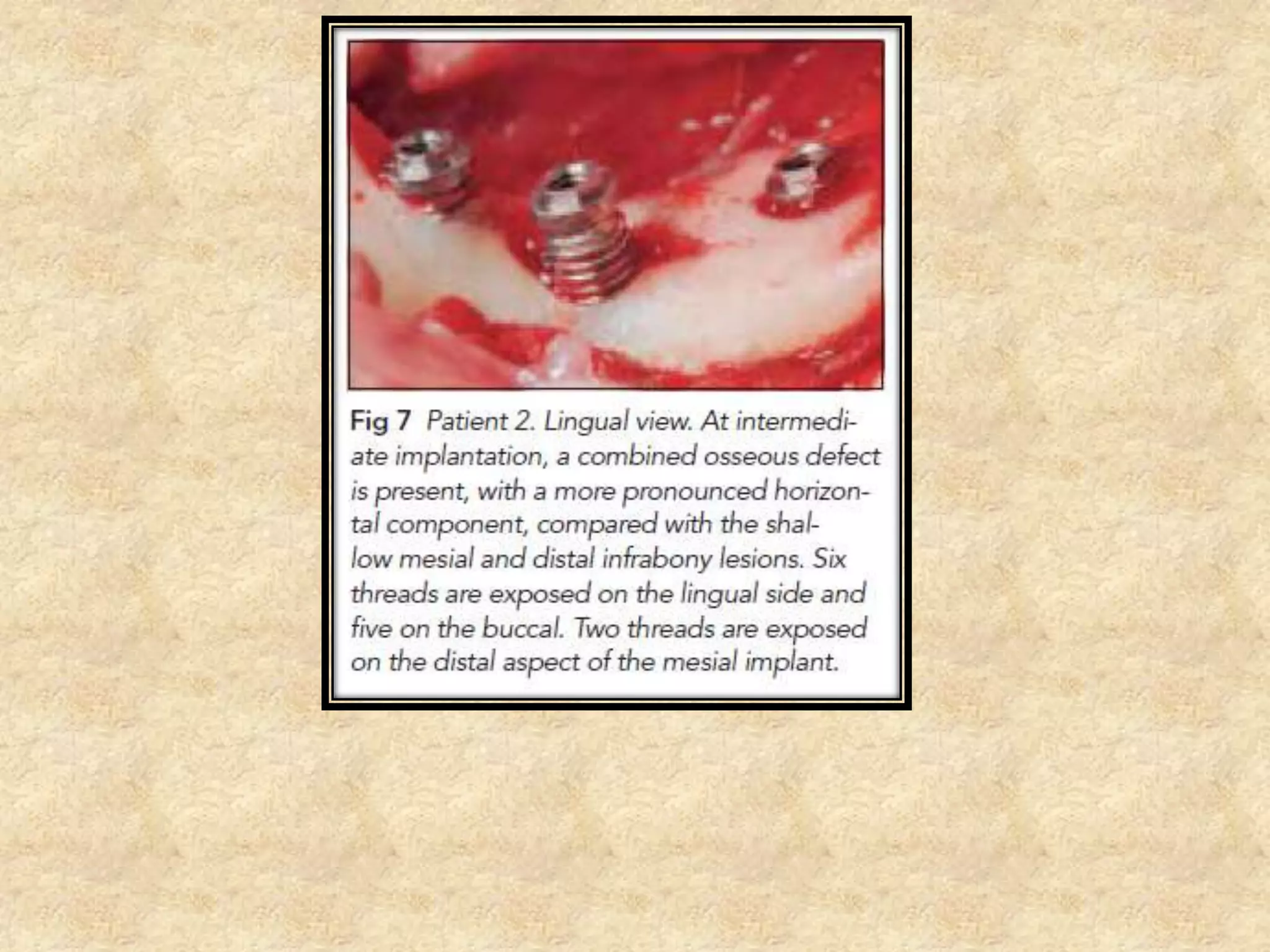 Peri implantitis treatment with regenerative approach | PPTX