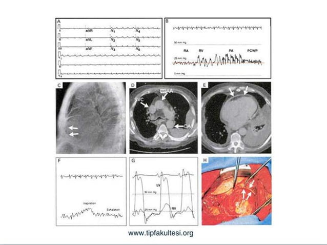 Perikardit(fazlası için www.tipfakultesi.org) | PPT