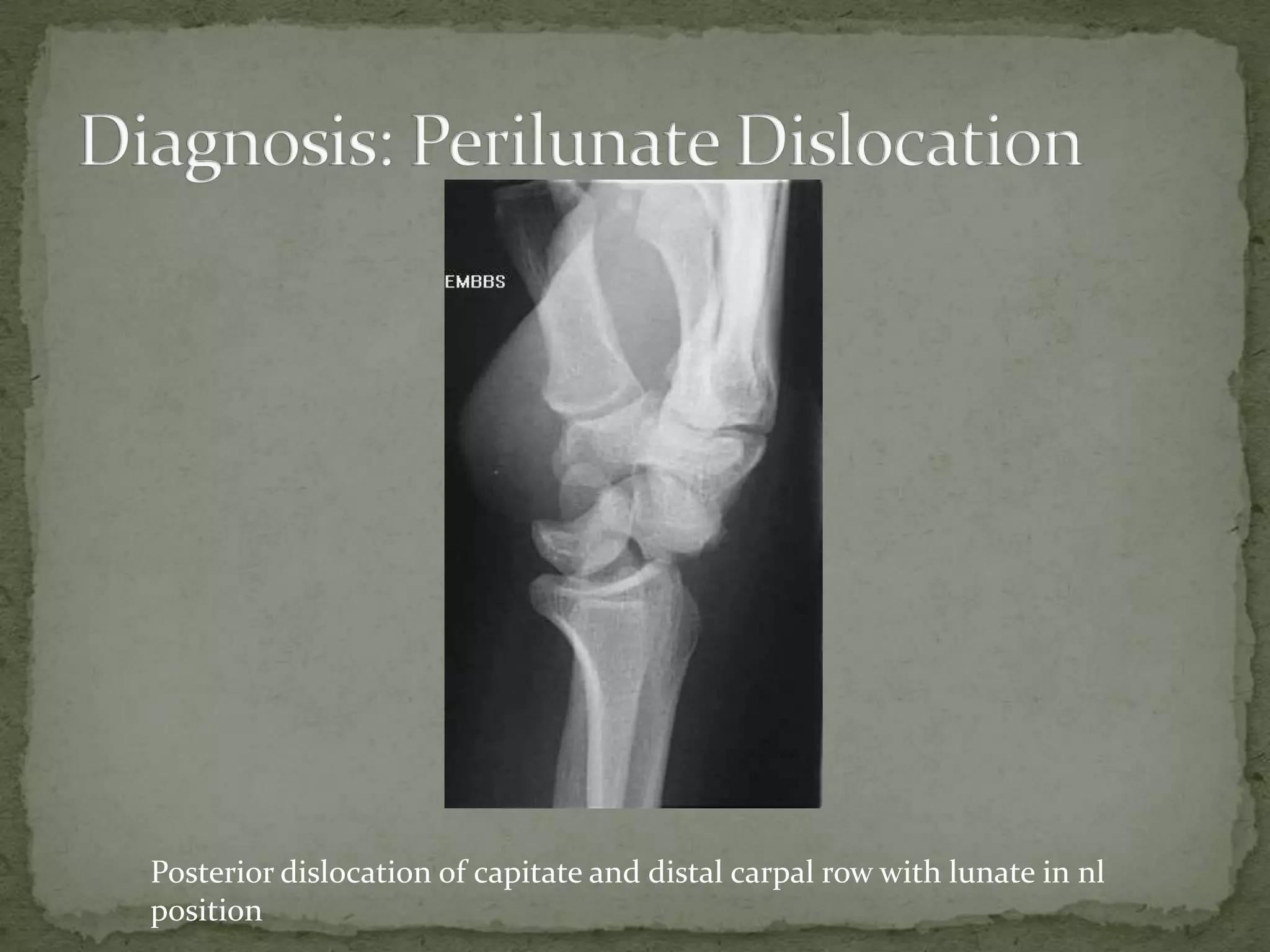 Perilunate dislocation | PPTX