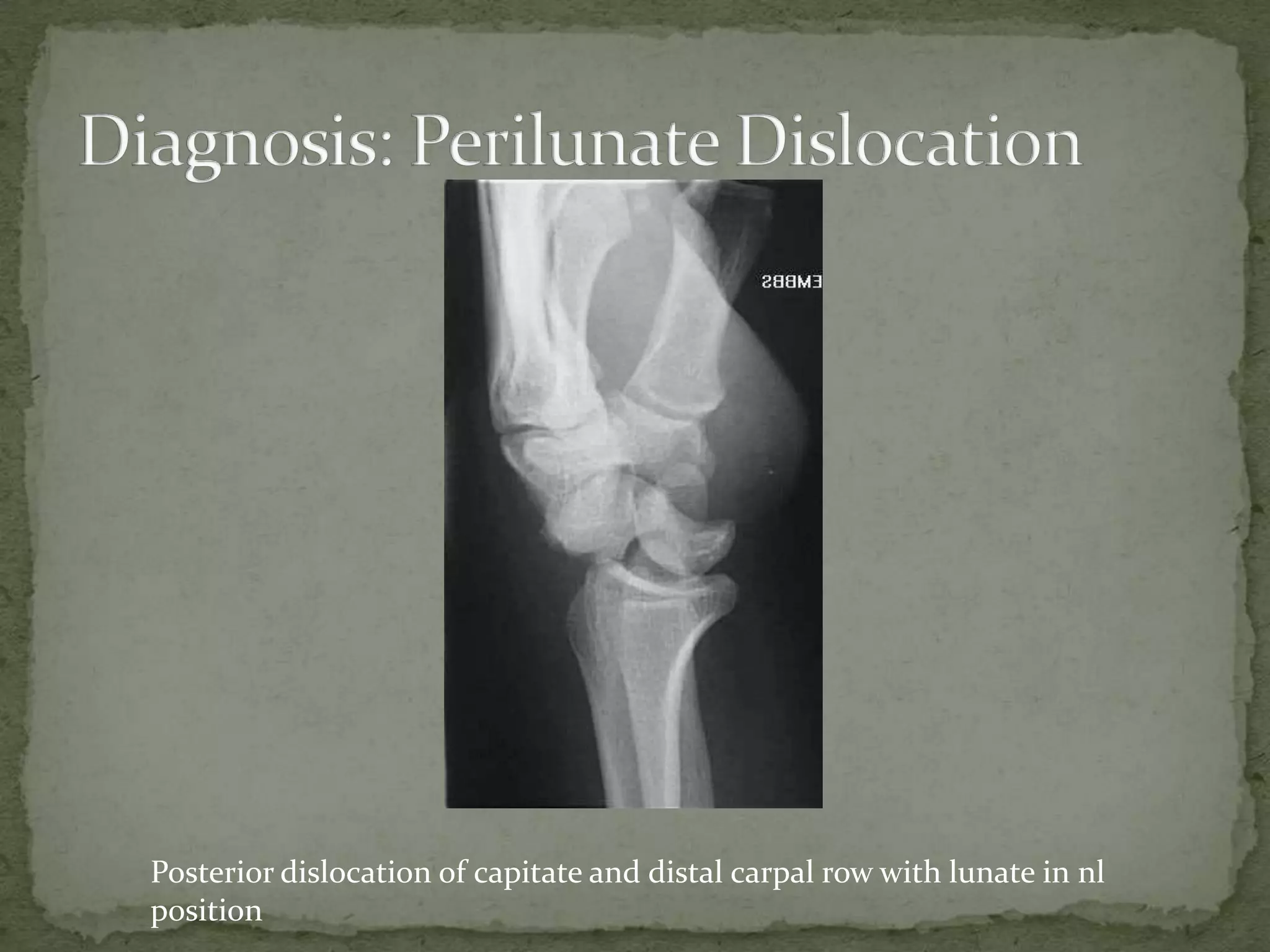 Perilunate dislocation Power Point | PPTX