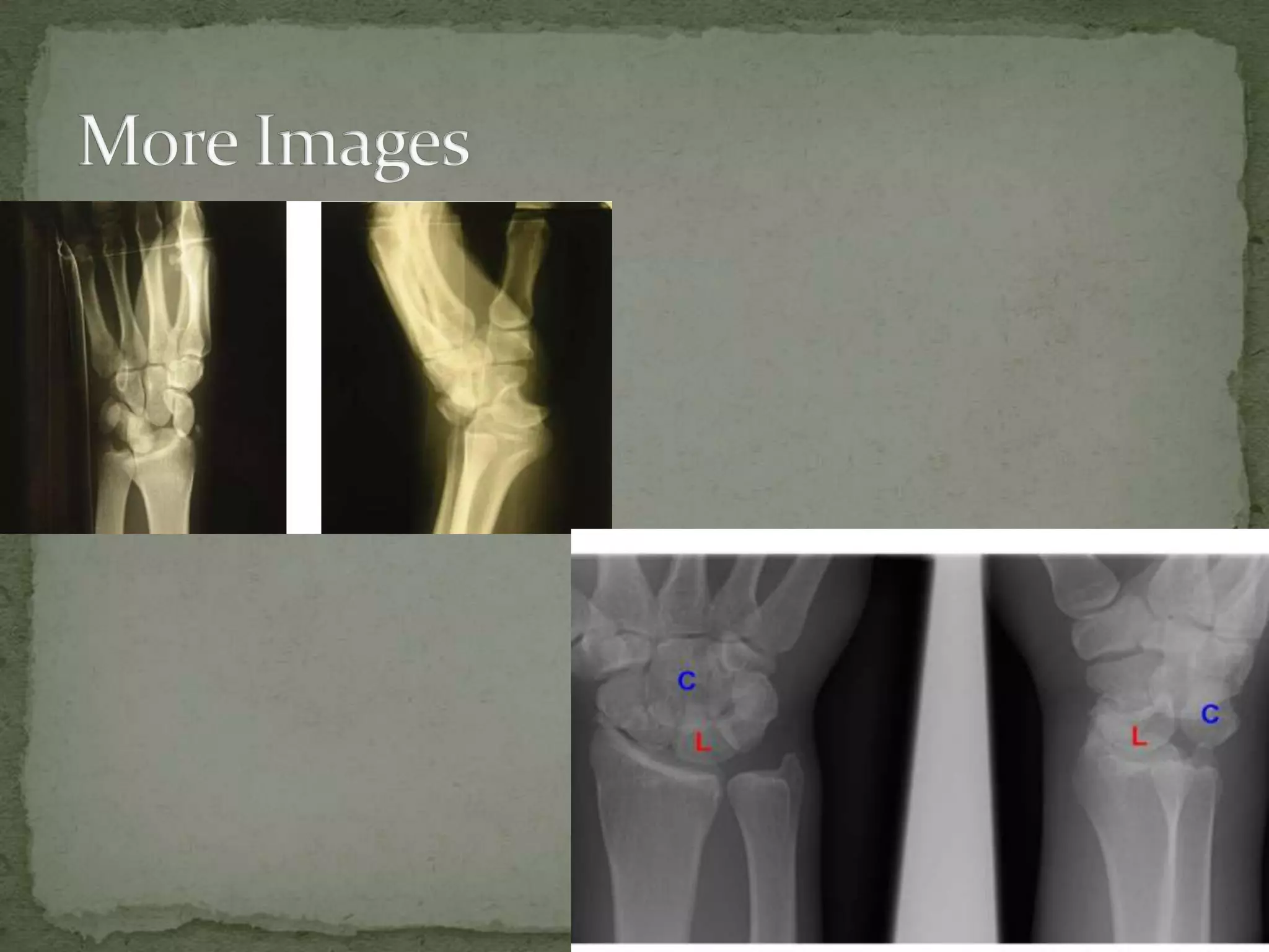 Perilunate dislocation Power Point | PPTX