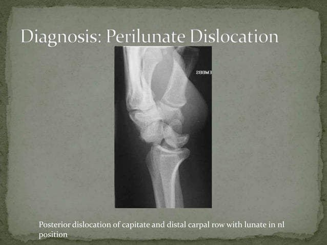 Perilunate dislocation Power Point | PPTX | Death, Injury, or Military ...