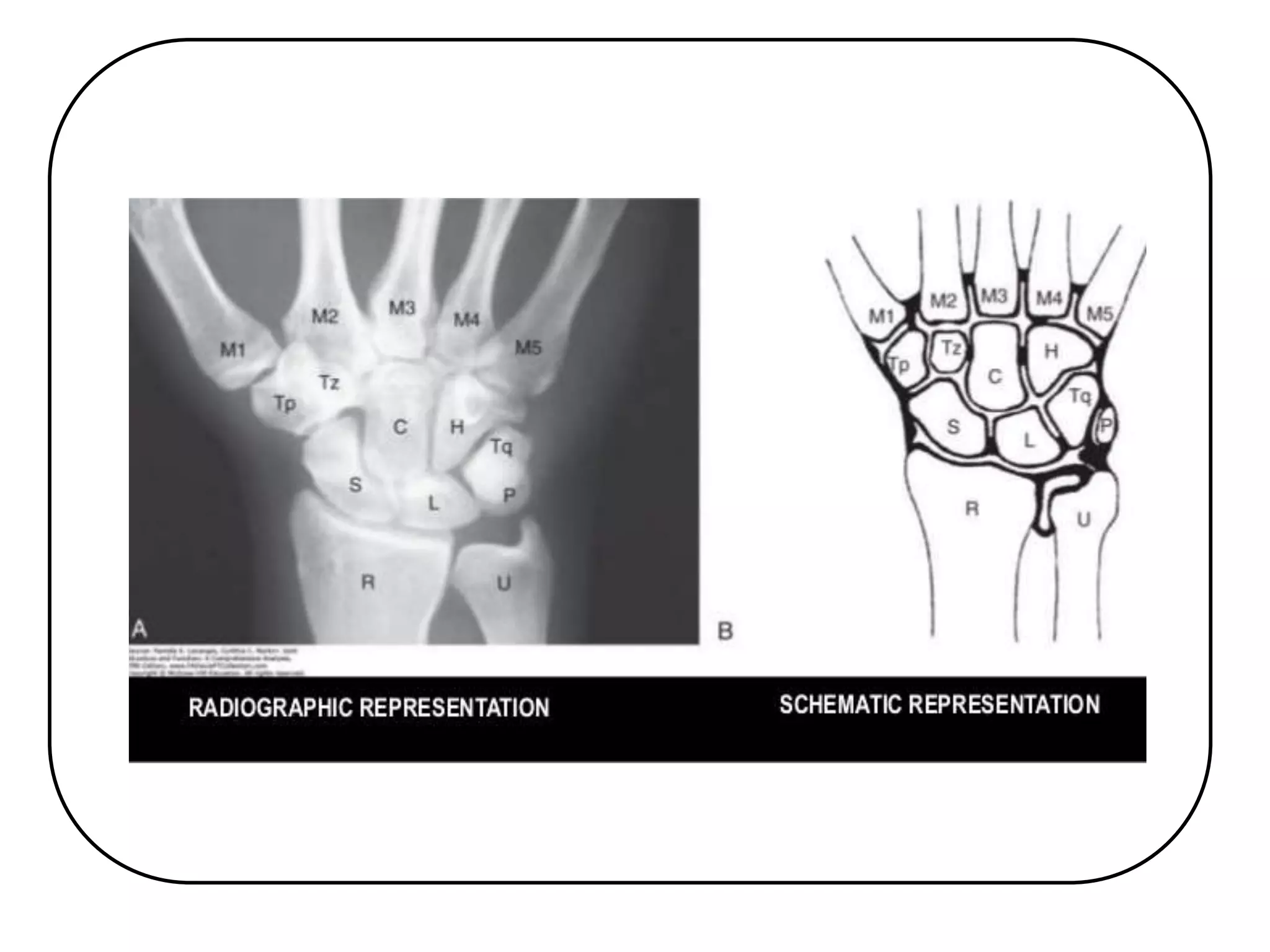 Lunate Fracture & Perilunate dislocation of carpals by Dr.@rpan ...