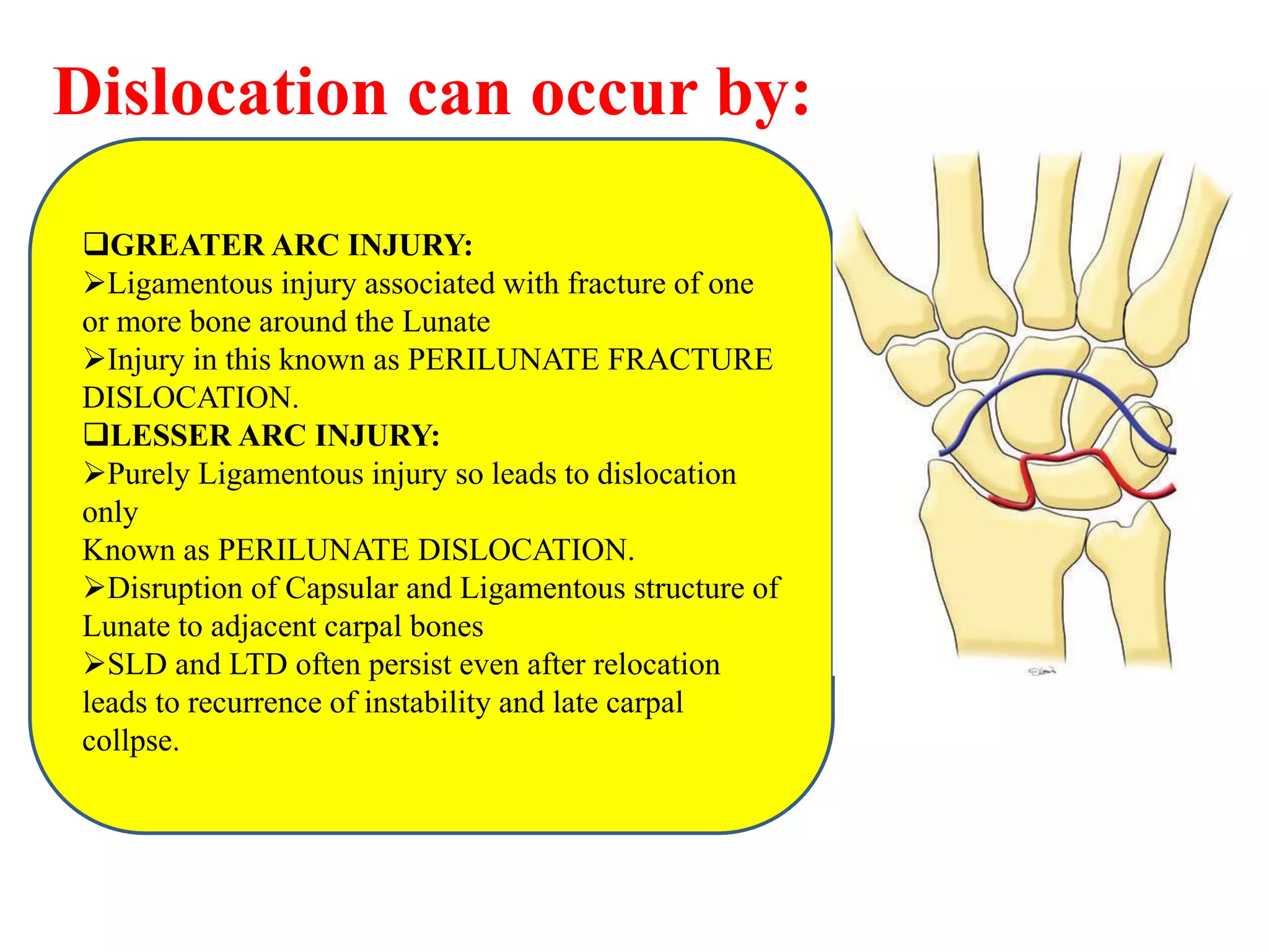 Lunate Fracture & Perilunate dislocation of carpals by Dr.@rpan Chaudhary (Resident M.S ...