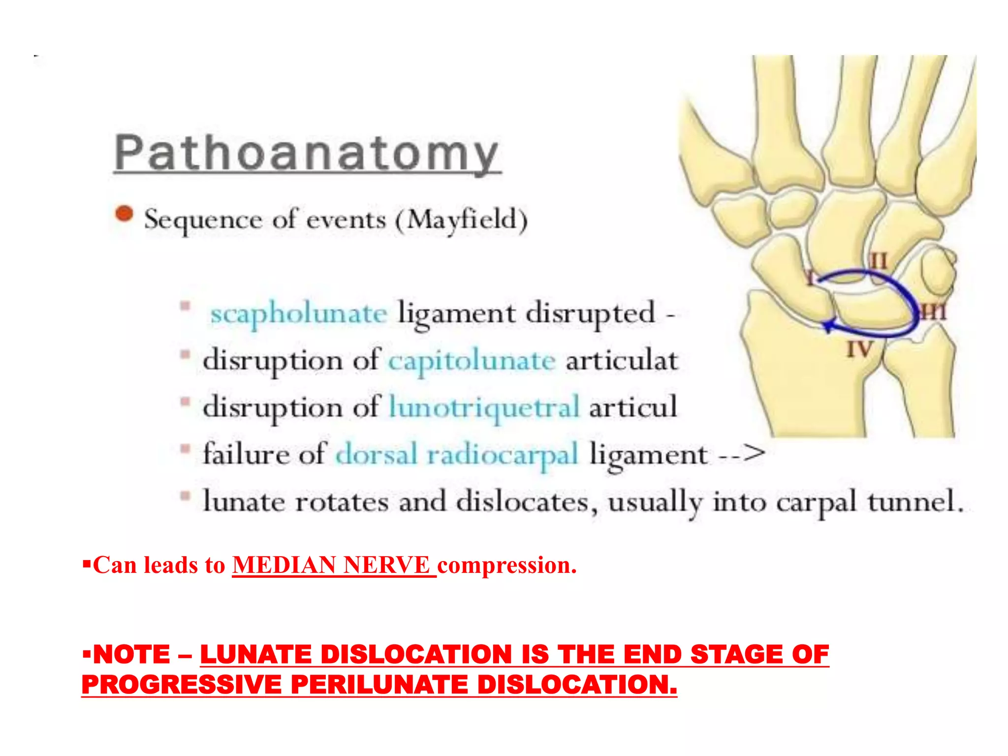 Lunate Fracture & Perilunate dislocation of carpals by Dr.@rpan ...