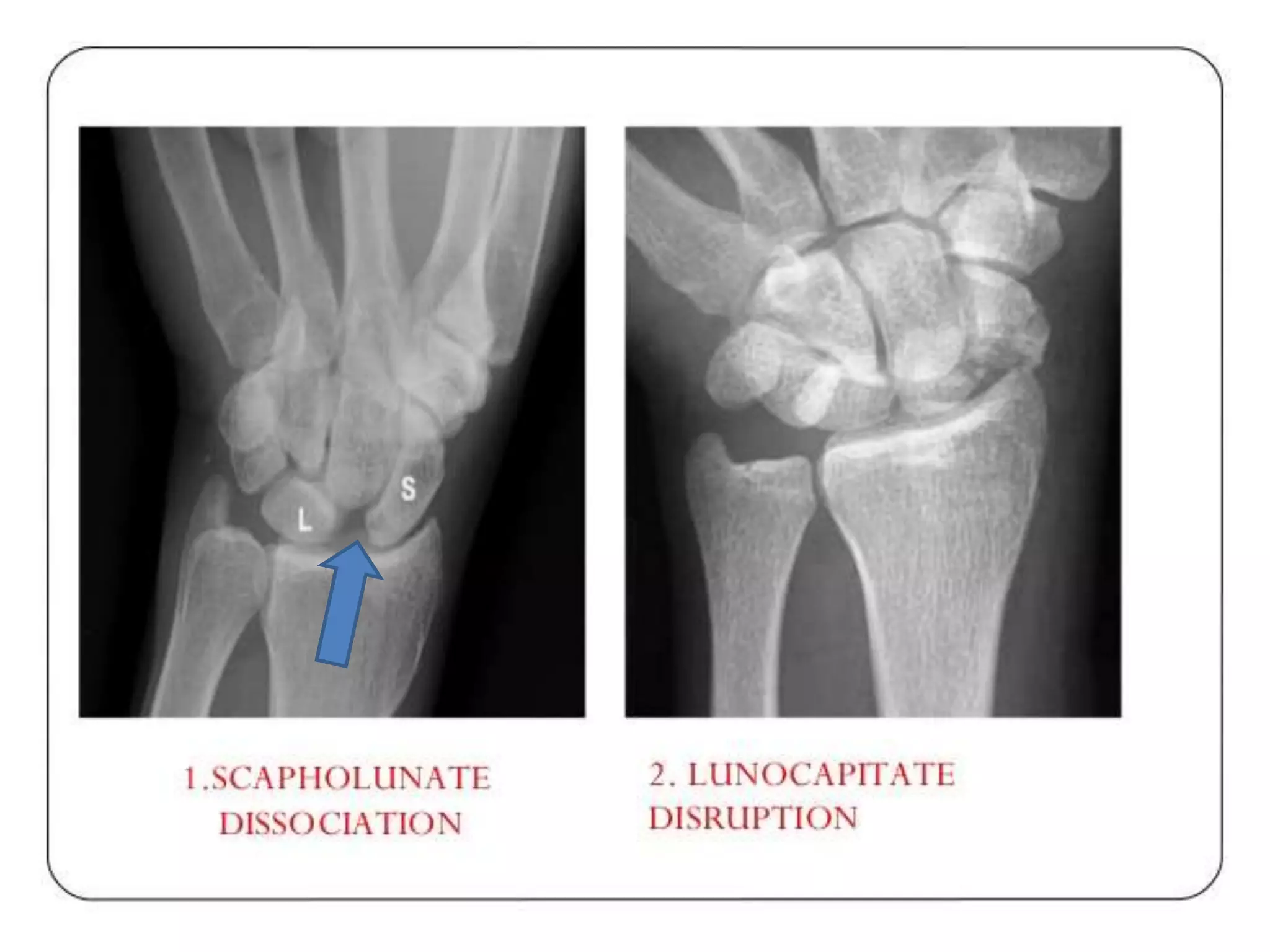 Lunate Fracture & Perilunate dislocation of carpals by Dr.@rpan Chaudhary (Resident M.S ...