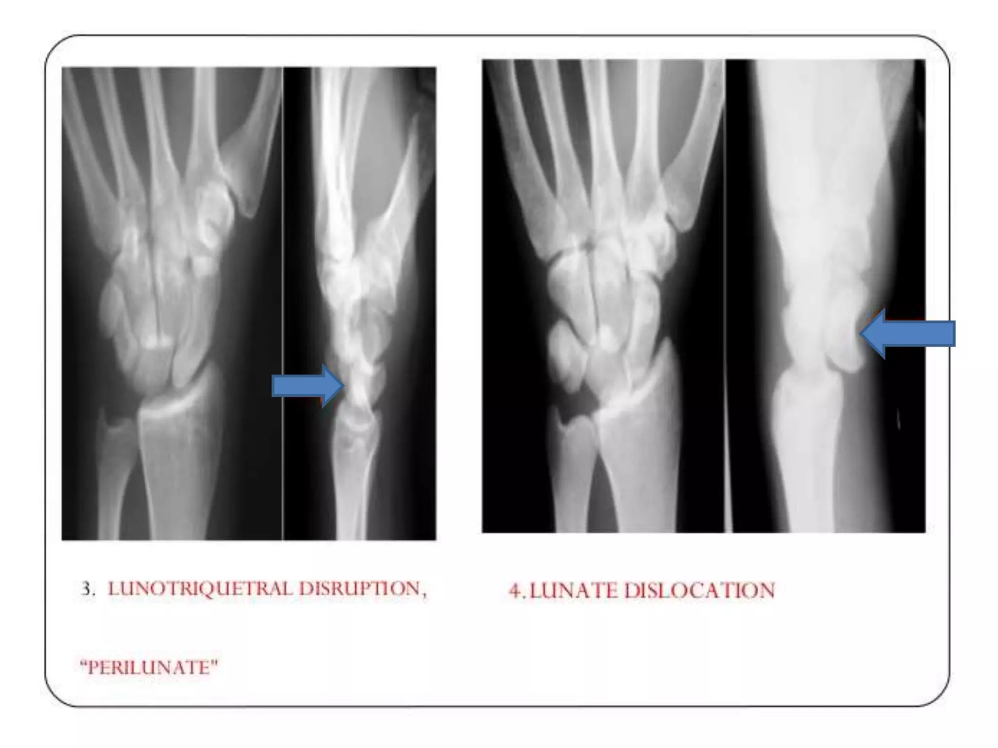 Lunate Fracture & Perilunate dislocation of carpals by Dr.@rpan Chaudhary (Resident M.S ...