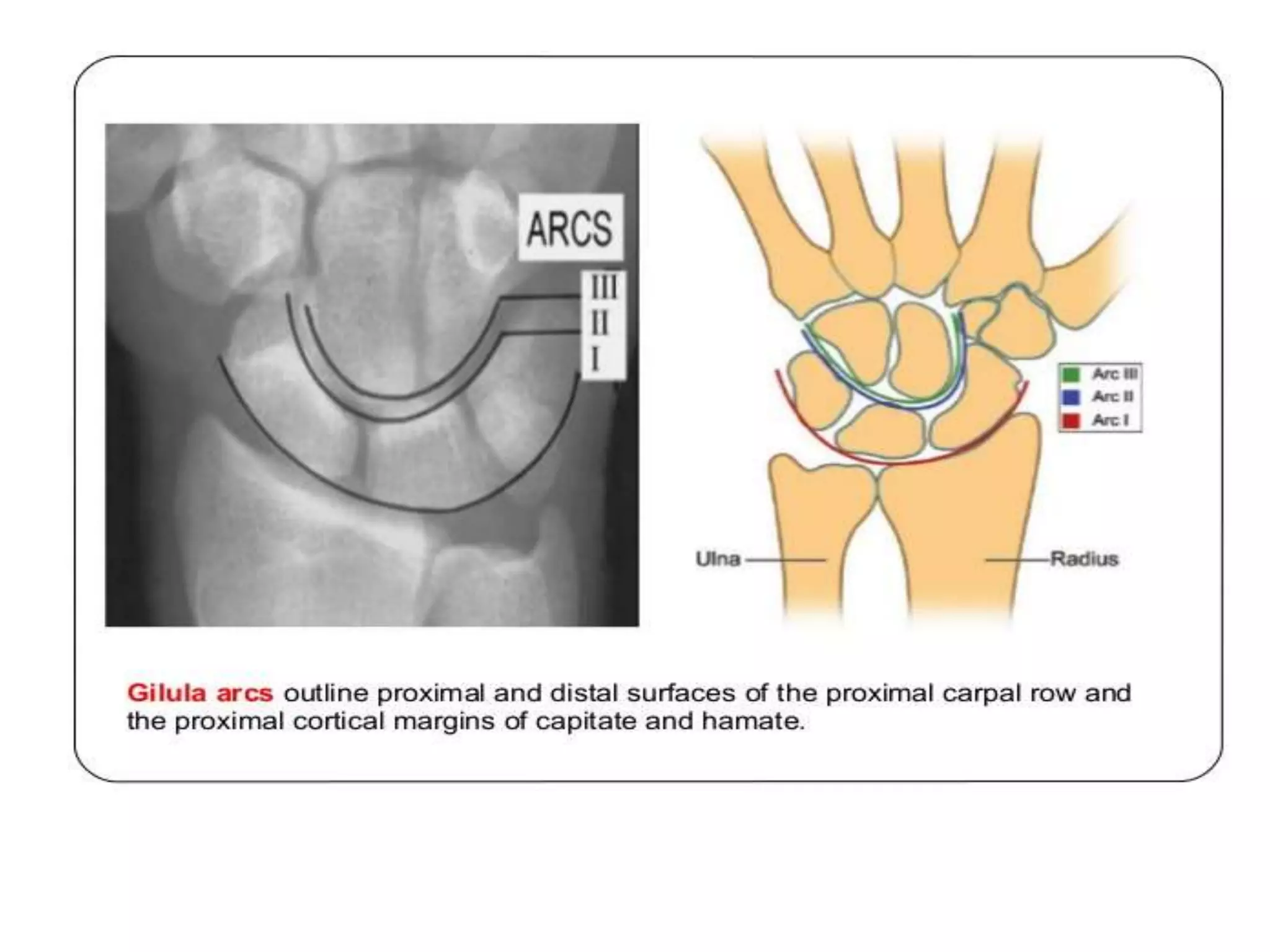 Lunate Fracture & Perilunate dislocation of carpals by Dr.@rpan ...