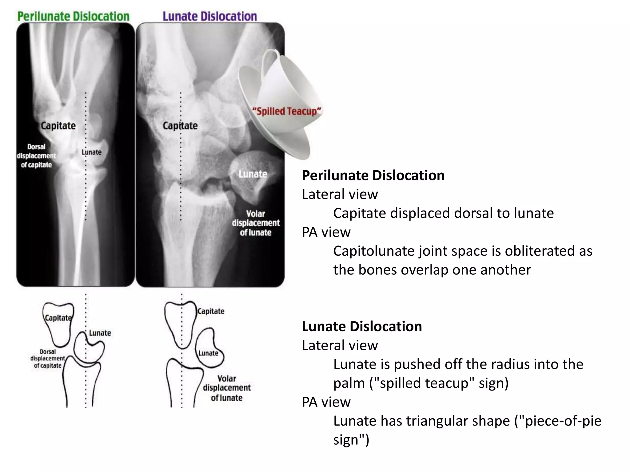 Lunate Fracture & Perilunate dislocation of carpals by Dr.@rpan ...