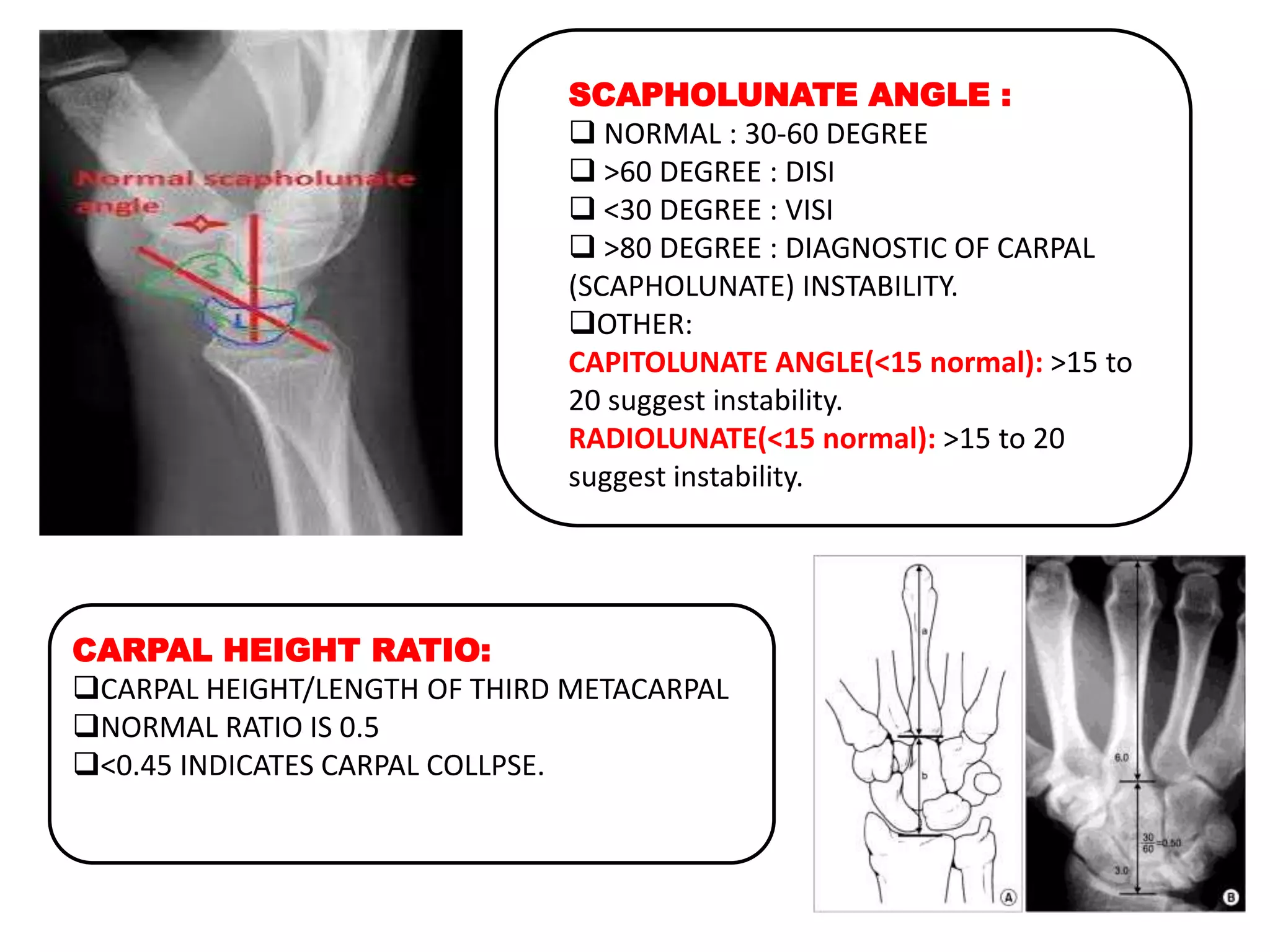 Lunate Fracture & Perilunate dislocation of carpals by Dr.@rpan ...