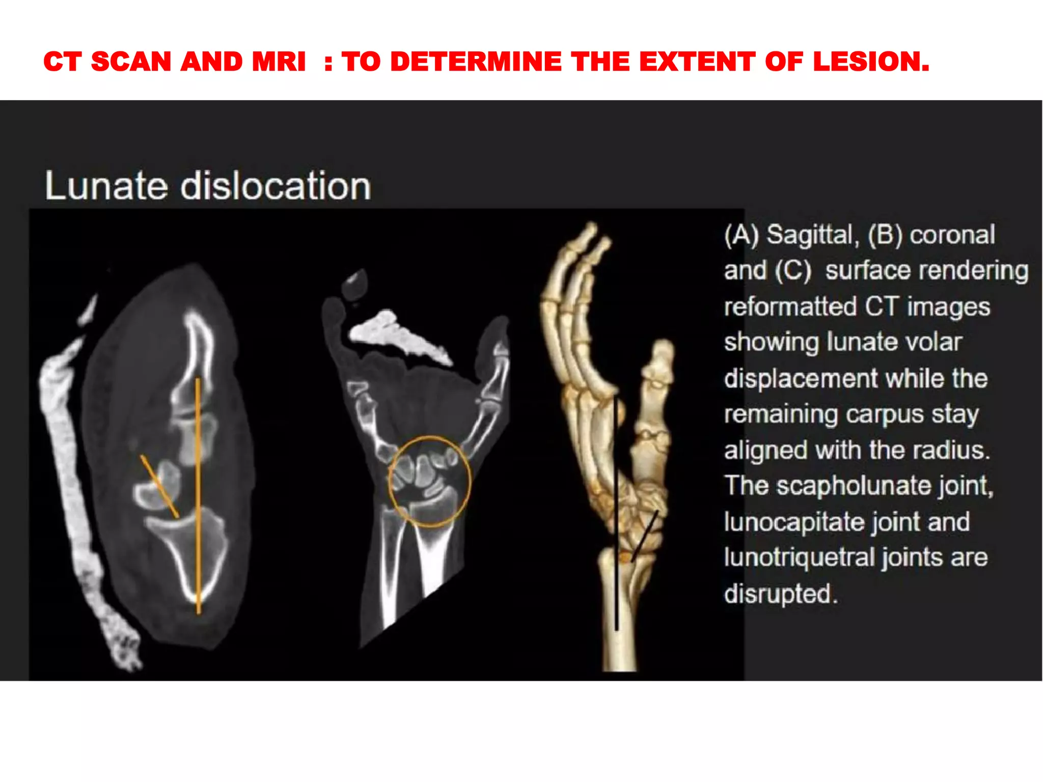Lunate Fracture & Perilunate dislocation of carpals by Dr.@rpan ...