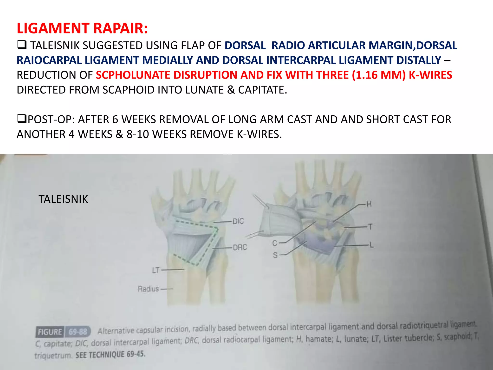 Lunate Fracture & Perilunate dislocation of carpals by Dr.@rpan ...